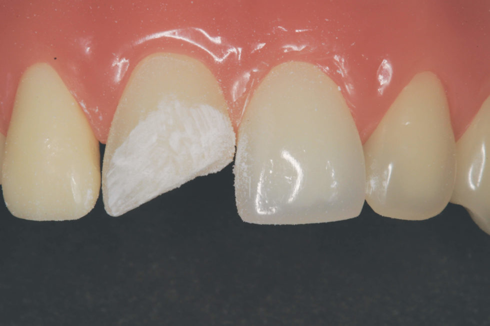 Mastering the Class IV Restoration - Brasseler USA - Dental