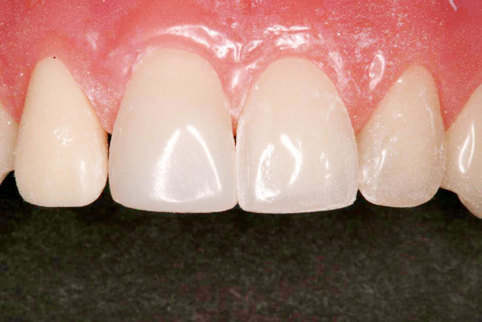 Mastering the Class IV Restoration - Brasseler USA - Dental